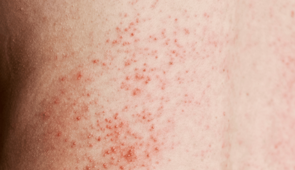 How Enticare Resolved a Chronic Skin Rash Linked to Mice