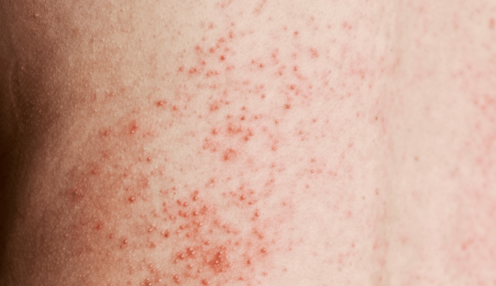Understanding Skin Rash from Mice: Causes and Prevention Tips ...